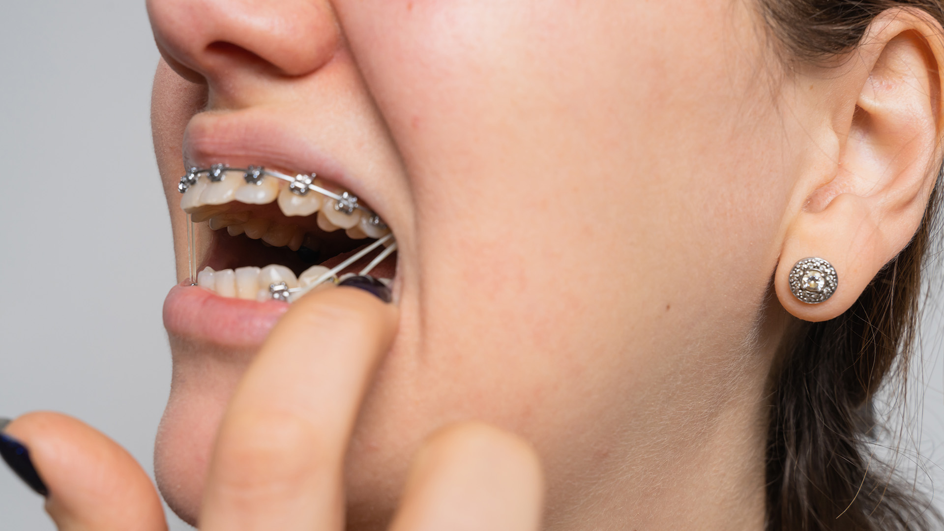 Types of Rubber Bands Braces Use | A Complete Guide